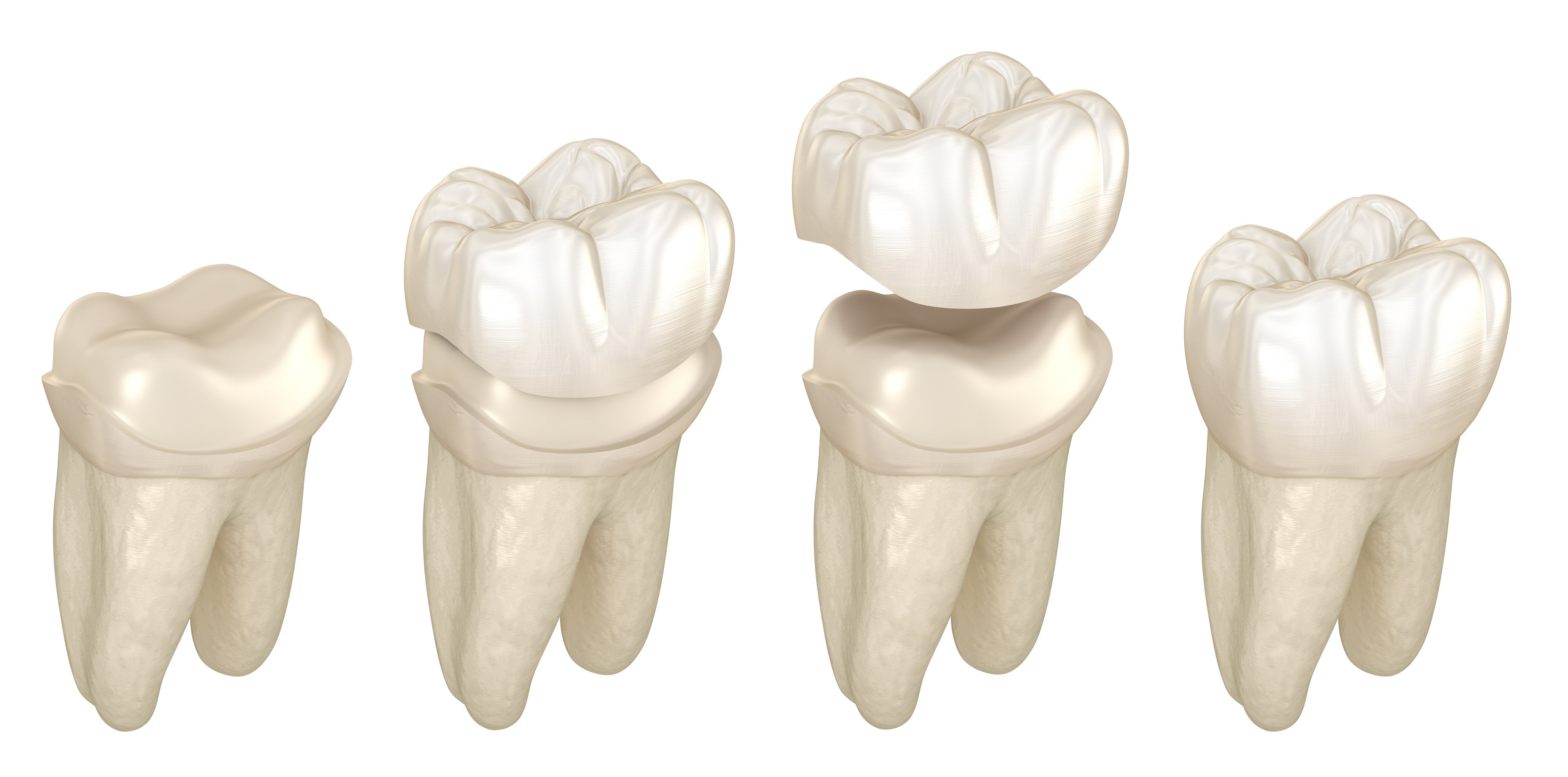 Restoration Crowns - Palmetto Dental Arts : Palmetto Dental Arts