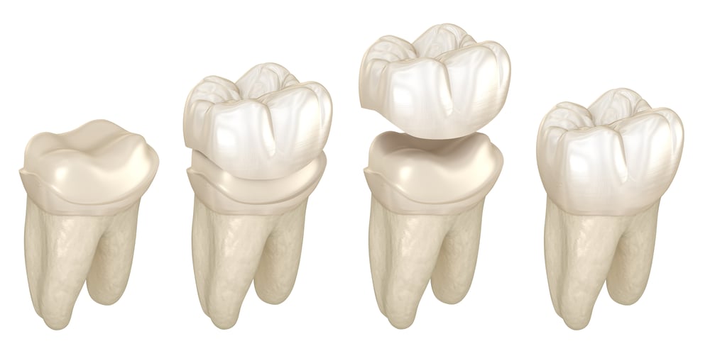 Restoration Crowns - Palmetto Dental Arts : Palmetto Dental Arts